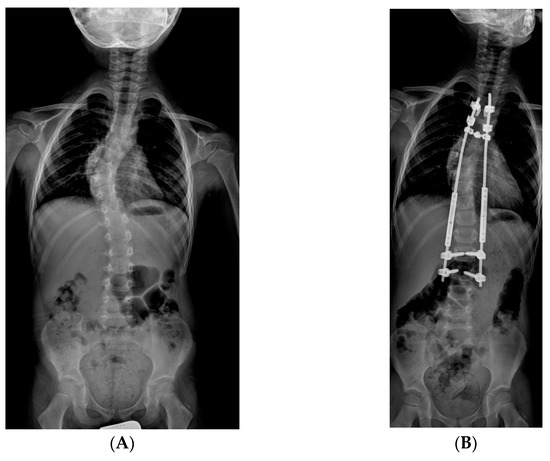 Surgical Treatment of Early-Onset Scoliosis: Traditional Growing Rod vs ...