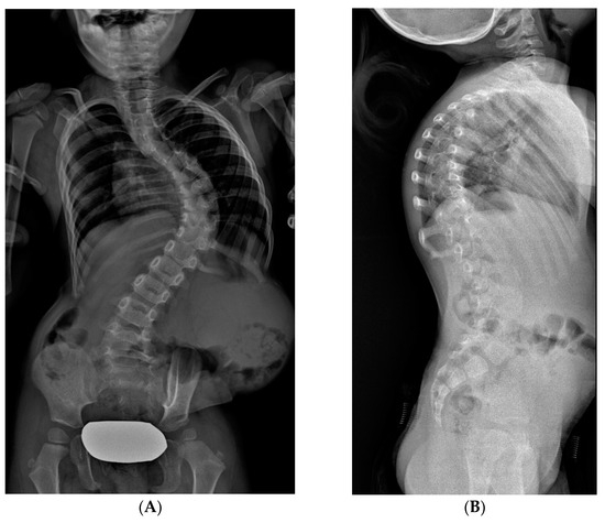Surgical Treatment of Early-Onset Scoliosis: Traditional Growing Rod vs ...