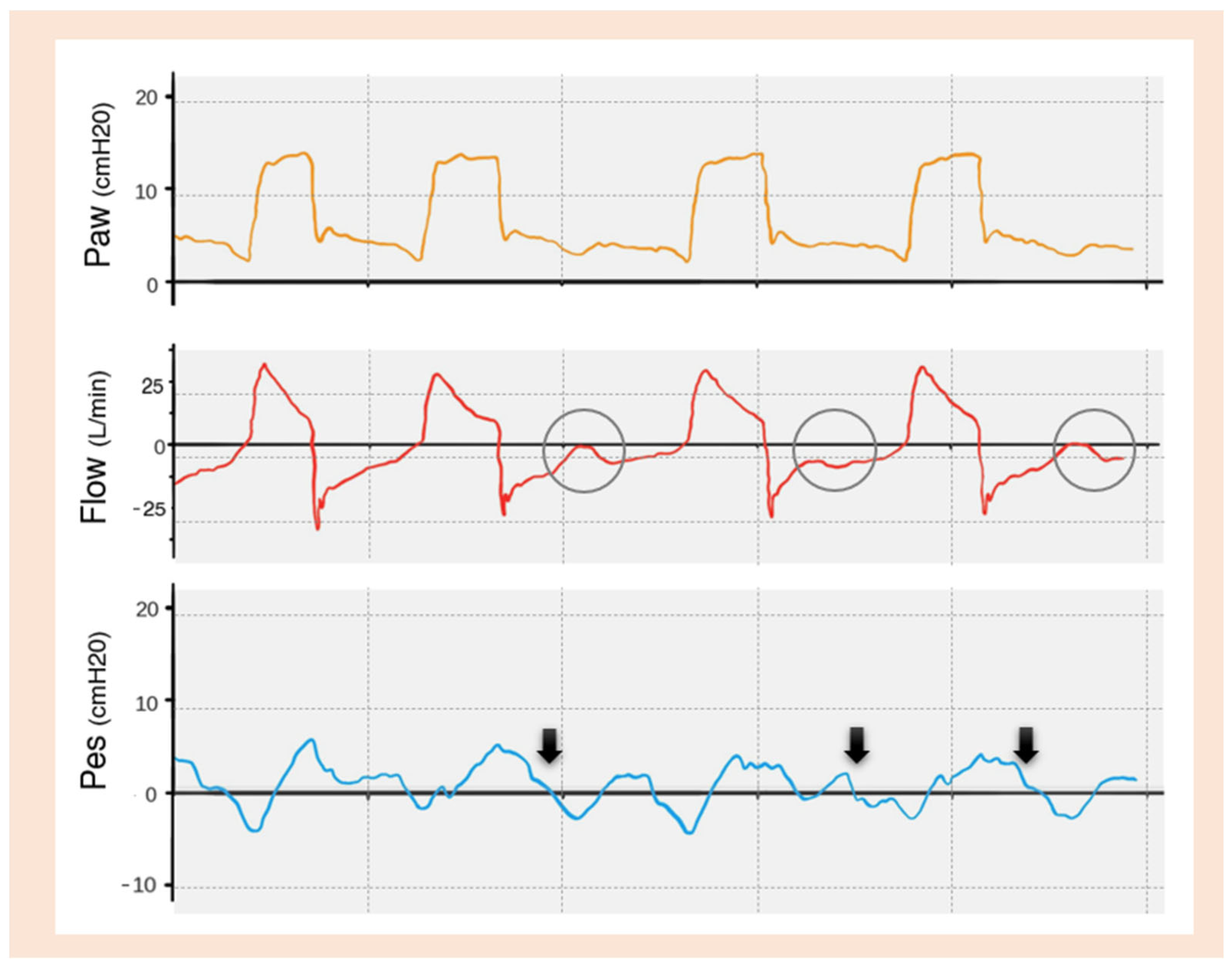 Optimizing Mechanical Ventilation: A Clinical and Practical Bedside Method for the ...