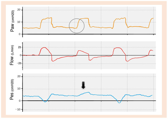 Optimizing Mechanical Ventilation: A Clinical and Practical Bedside ...