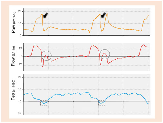 Optimizing Mechanical Ventilation: A Clinical and Practical Bedside ...