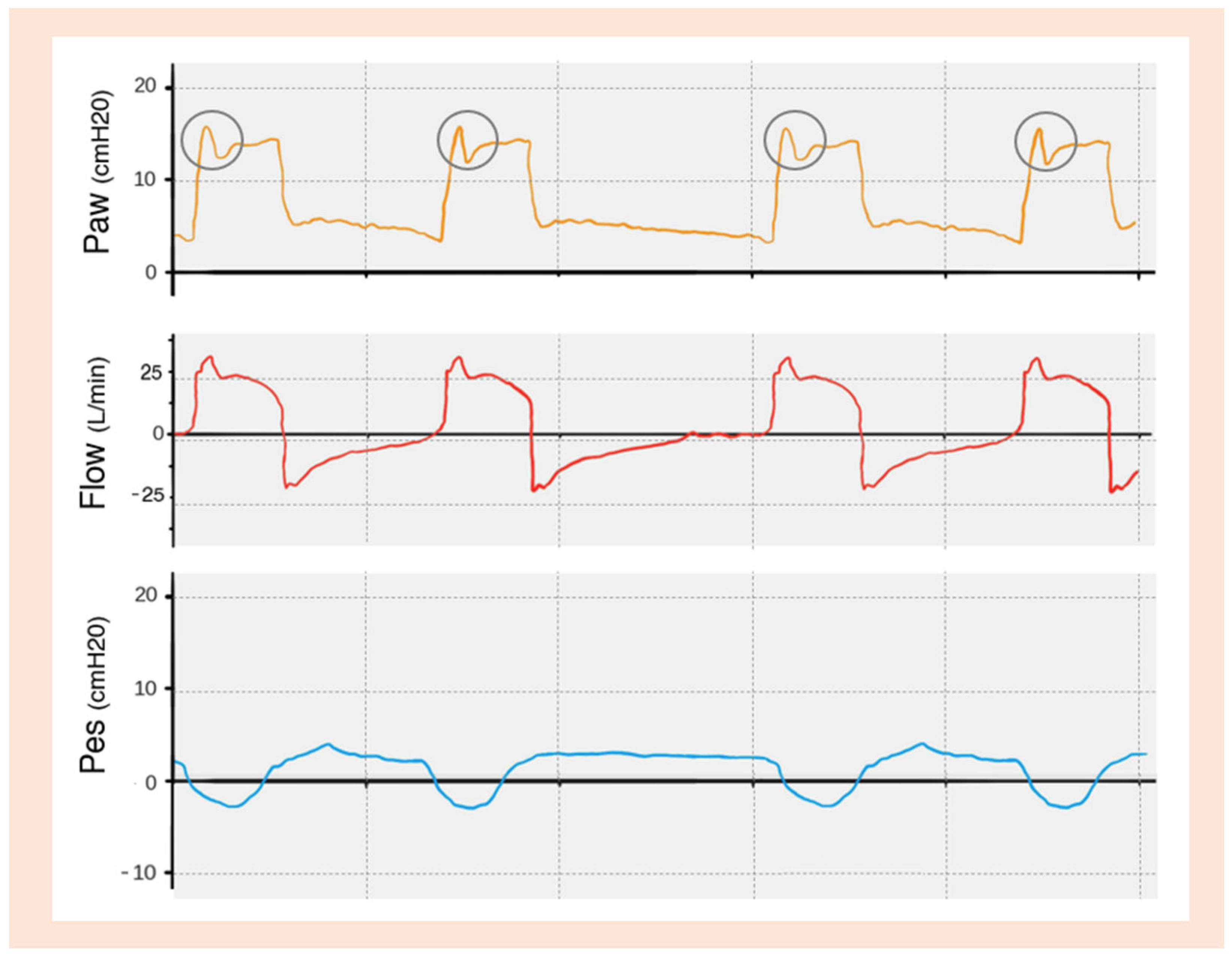 Optimizing Mechanical Ventilation: A Clinical and Practical Bedside Method for the ...