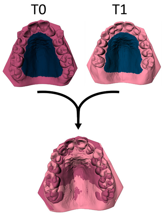 Second Versus First Molar Extractions in Class II Division 1 ...