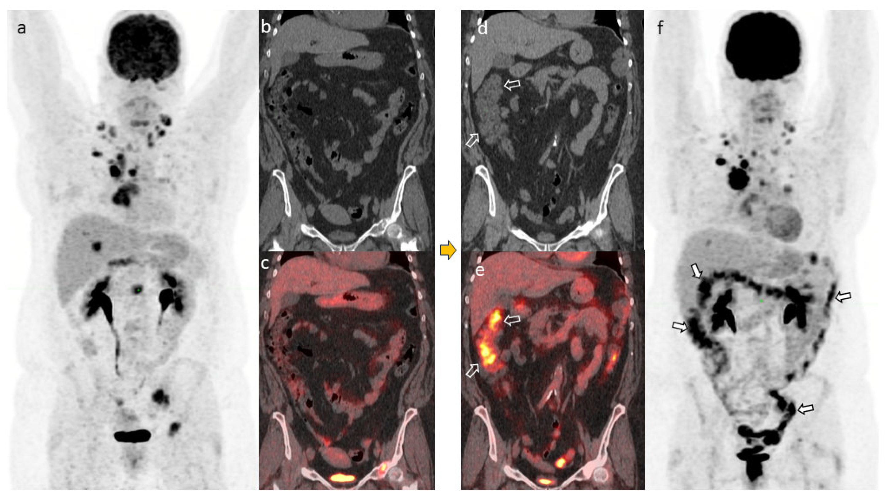 Predictive Value of FDG Uptake on PET for Future Immune Checkpoint ...