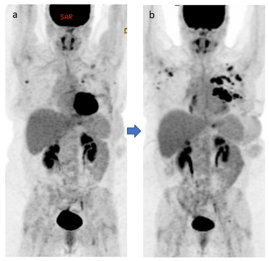 Predictive Value of FDG Uptake on PET for Future Immune Checkpoint ...