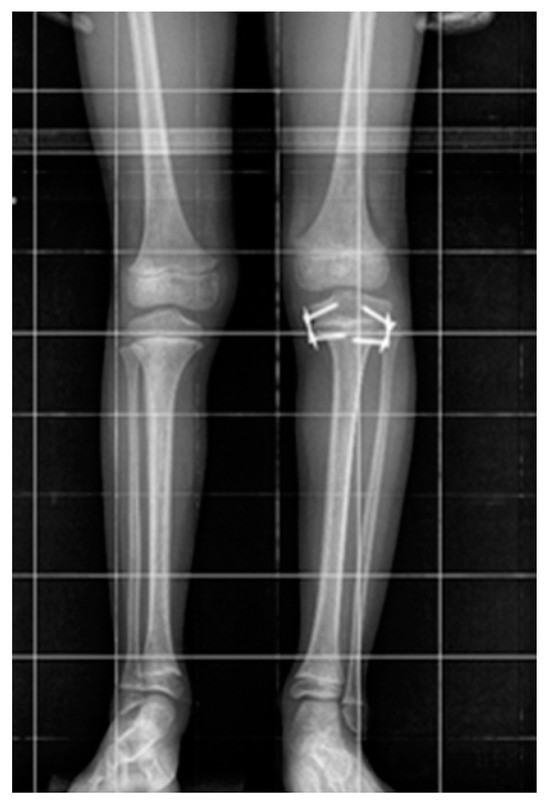 Limb Axis Disorder During Leg Length Discrepancy Treatment with ...
