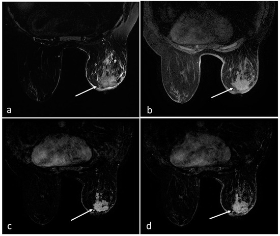 Diagnostic Performance of Kaiser Score for Characterization of Breast ...