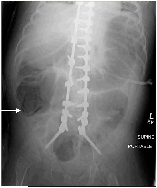 Utility of Abdominal Radiographs After Posterior Spinal Fusion for ...