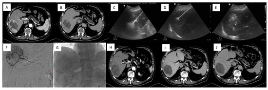 All You Need to Know About TACE: A Comprehensive Review of Indications ...