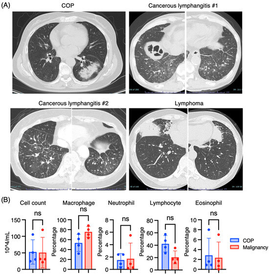 Immunophenotyping of T Cells in Lung Malignancies and Cryptogenic ...
