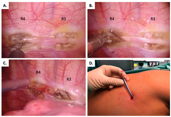 Predictors of Compensatory Sweating and Satisfaction Following ...