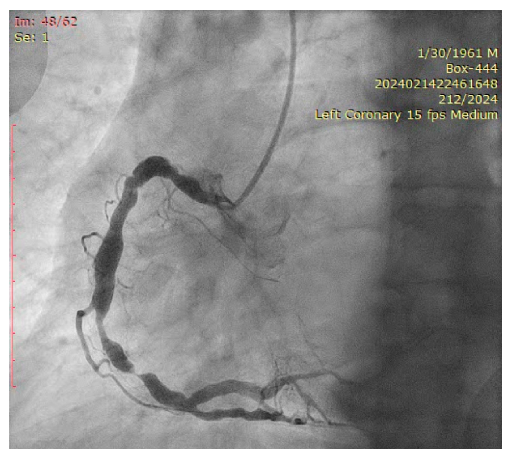 Complex Left Main Trifurcation: A Case Study of Successful Treatment