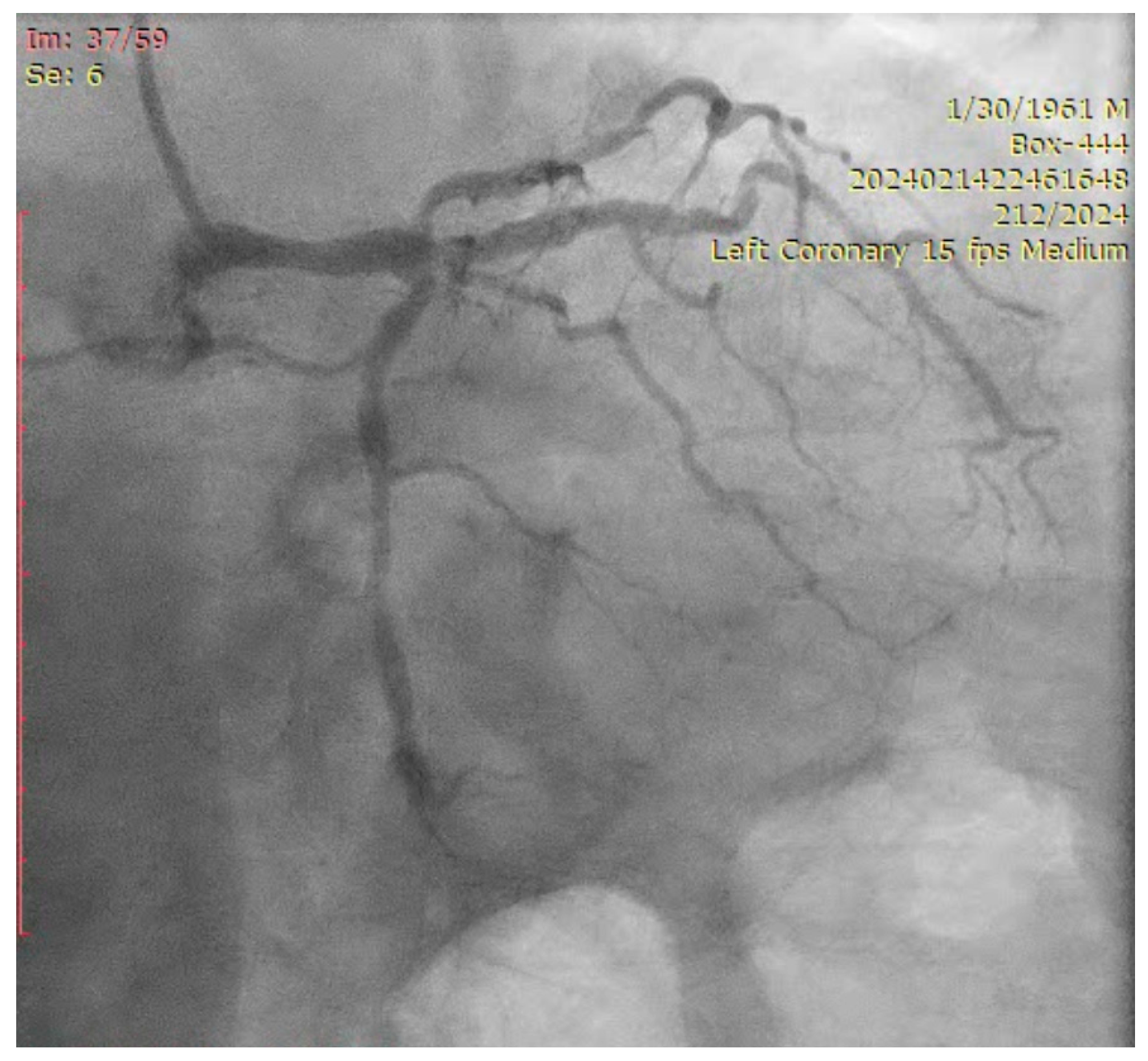 Complex Left Main Trifurcation: A Case Study of Successful Treatment