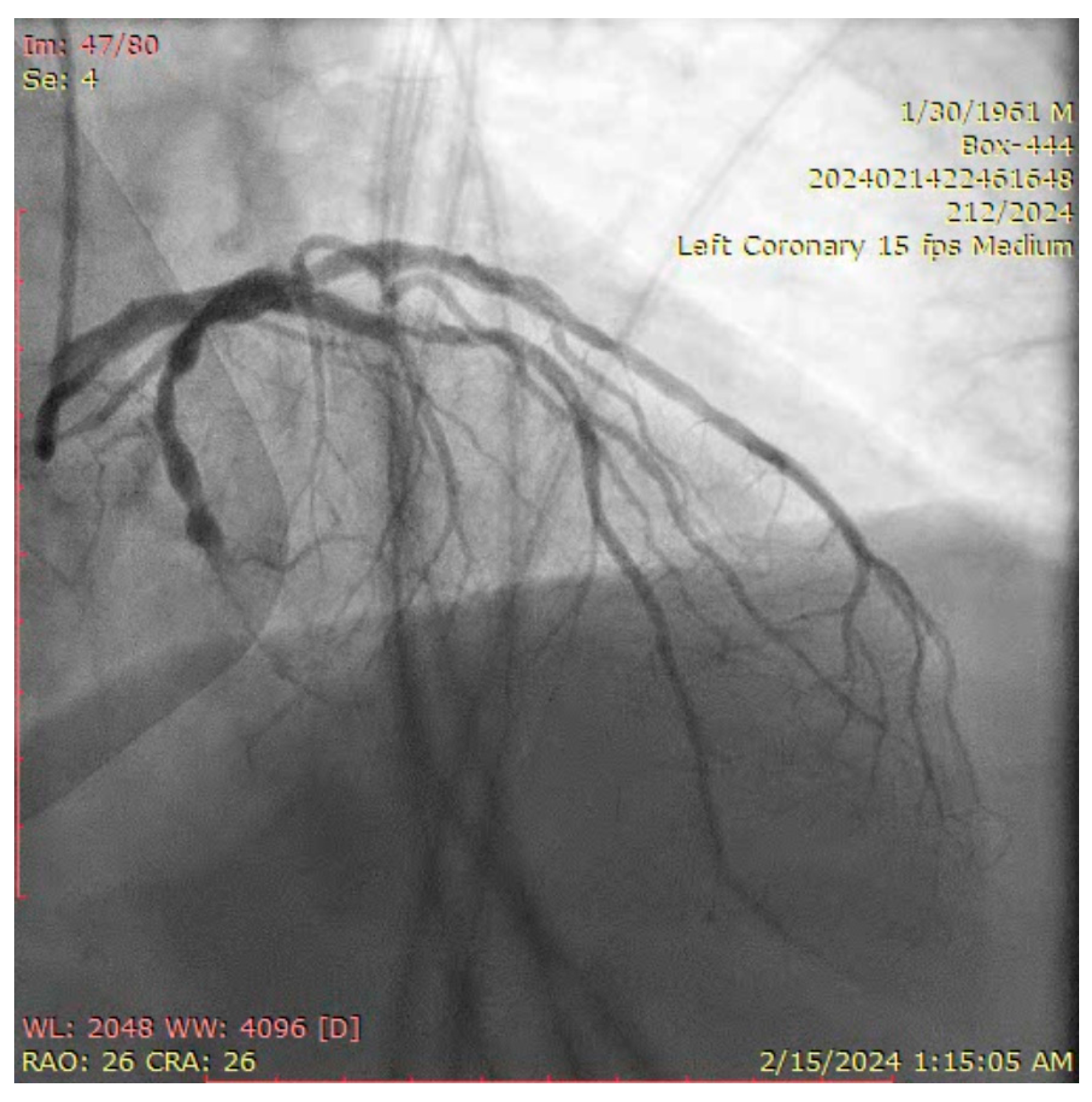 Complex Left Main Trifurcation: A Case Study of Successful Treatment