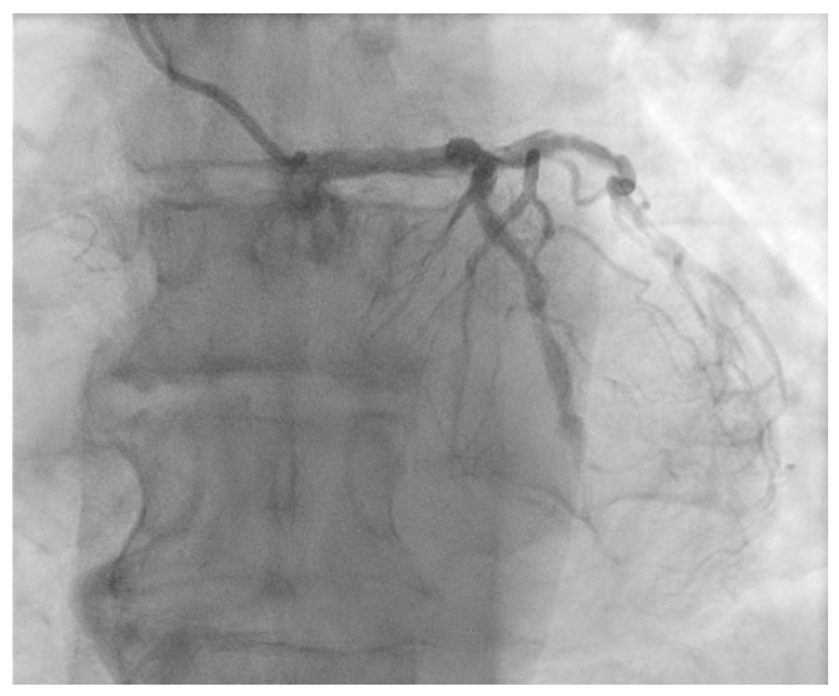Complex Left Main Trifurcation: A Case Study of Successful Treatment