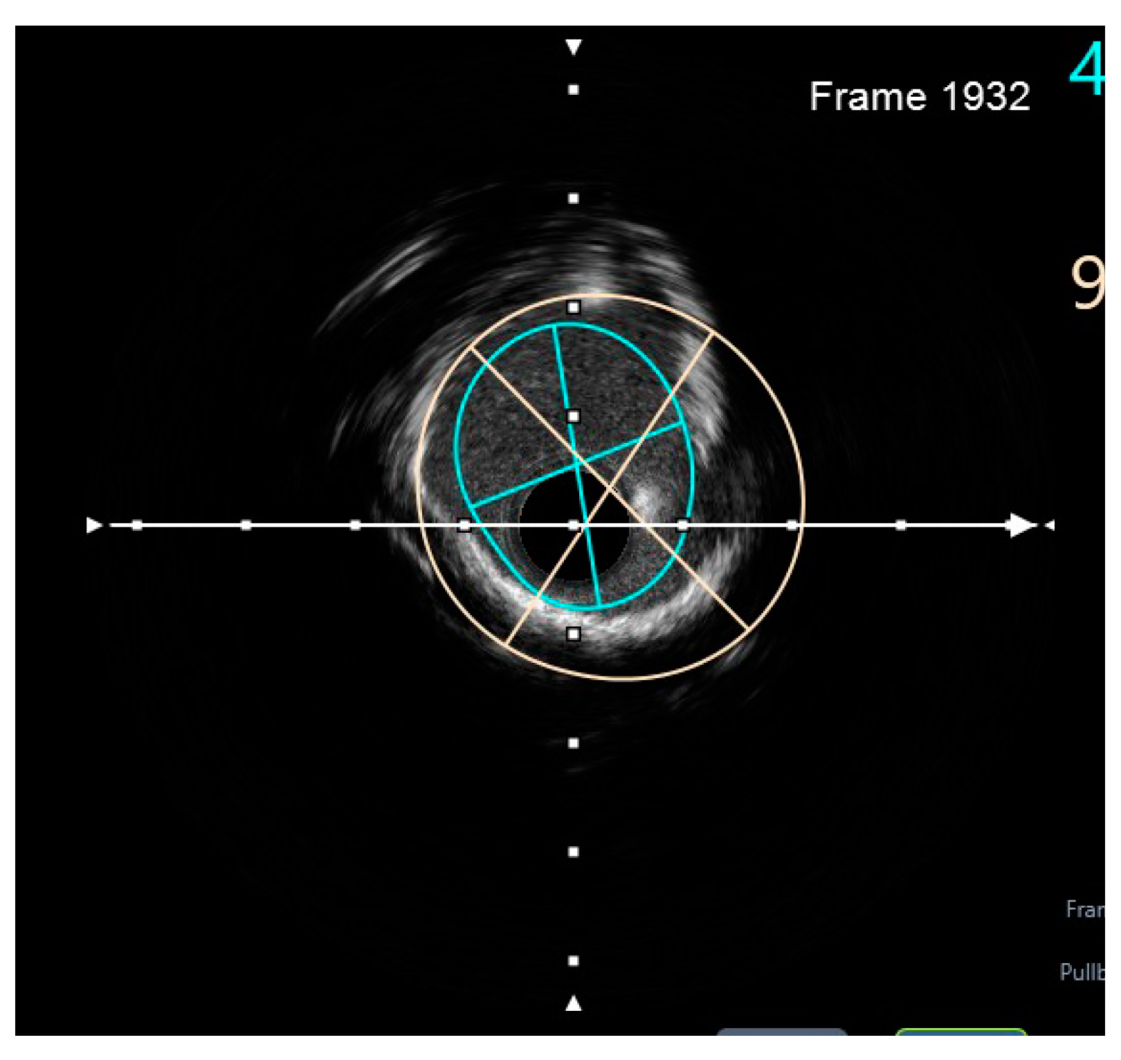 Complex Left Main Trifurcation: A Case Study of Successful Treatment