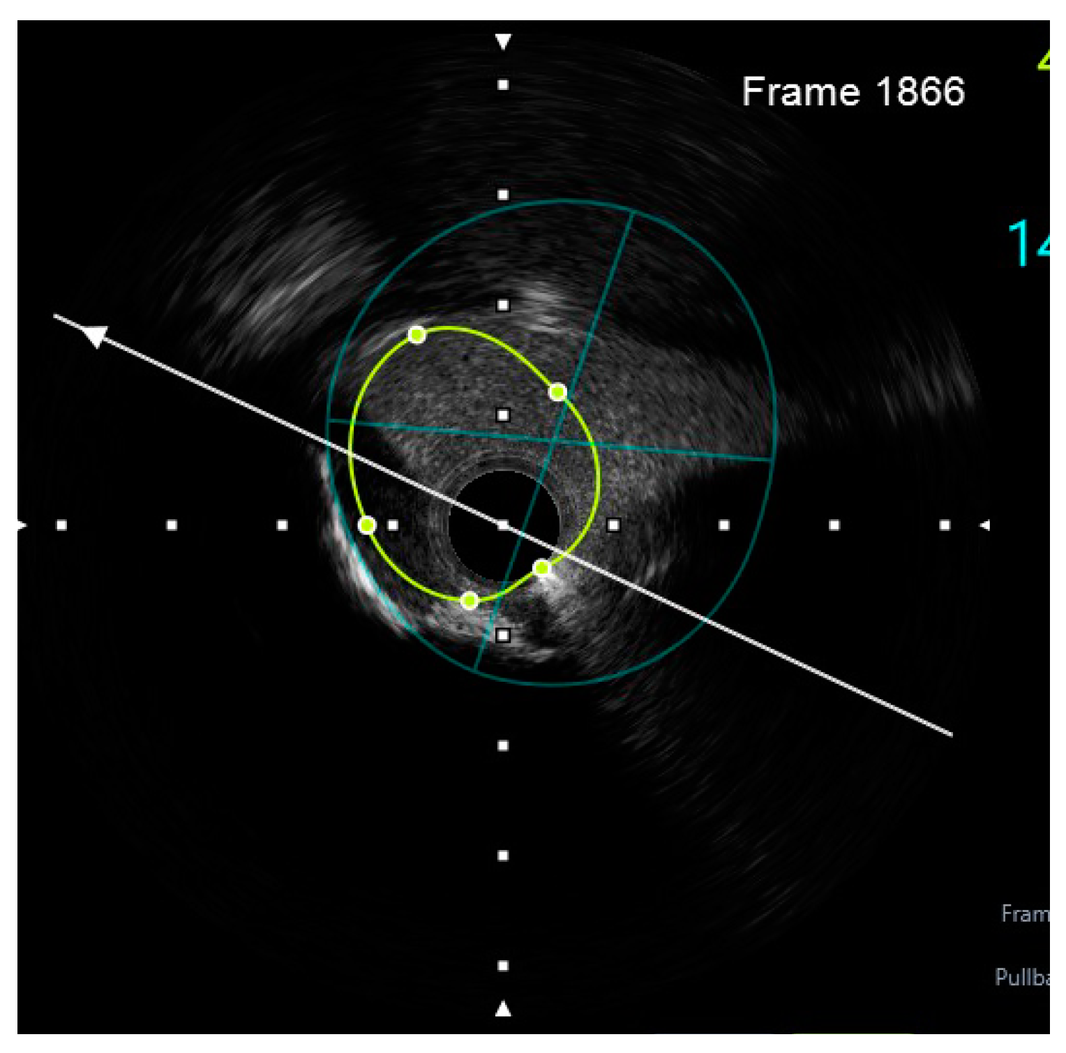 Complex Left Main Trifurcation: A Case Study of Successful Treatment