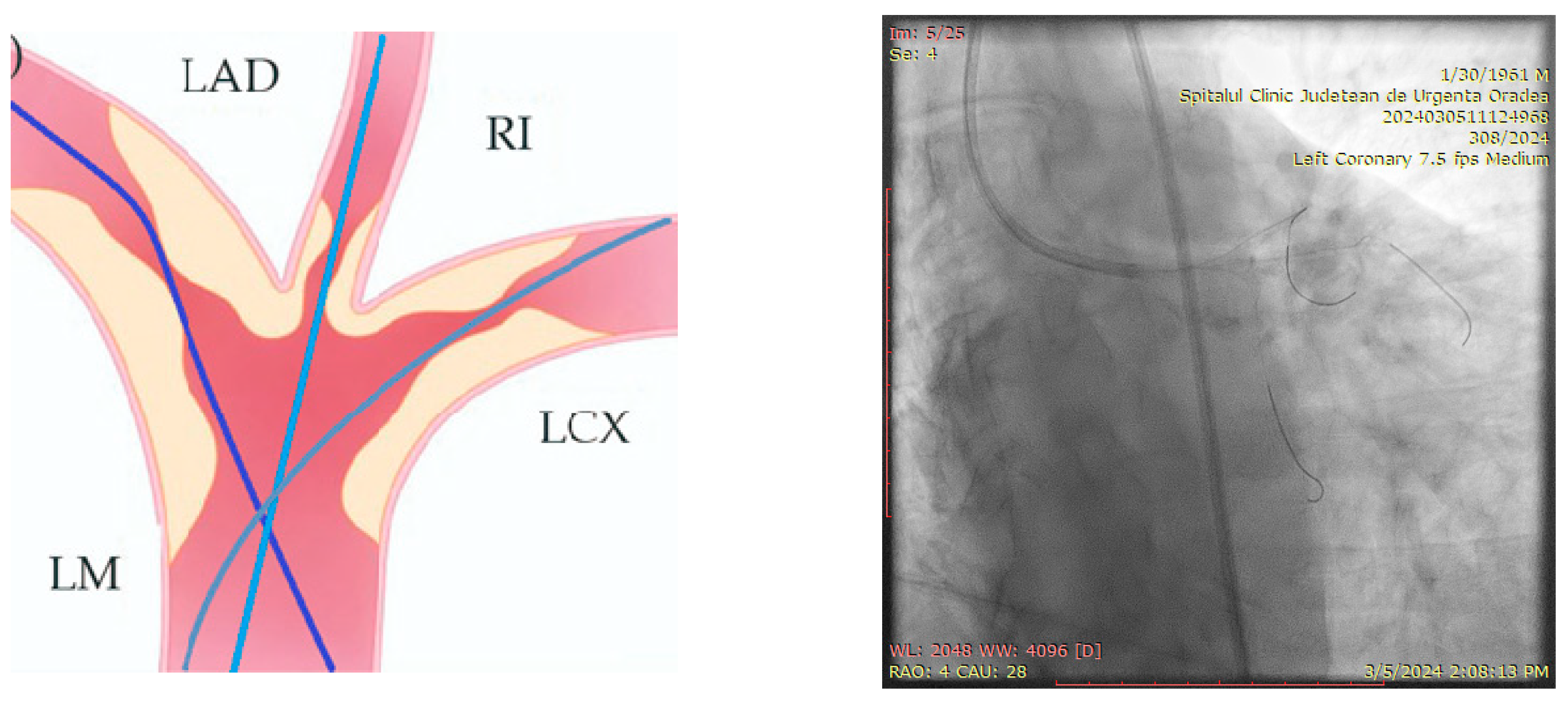 Complex Left Main Trifurcation: A Case Study of Successful Treatment