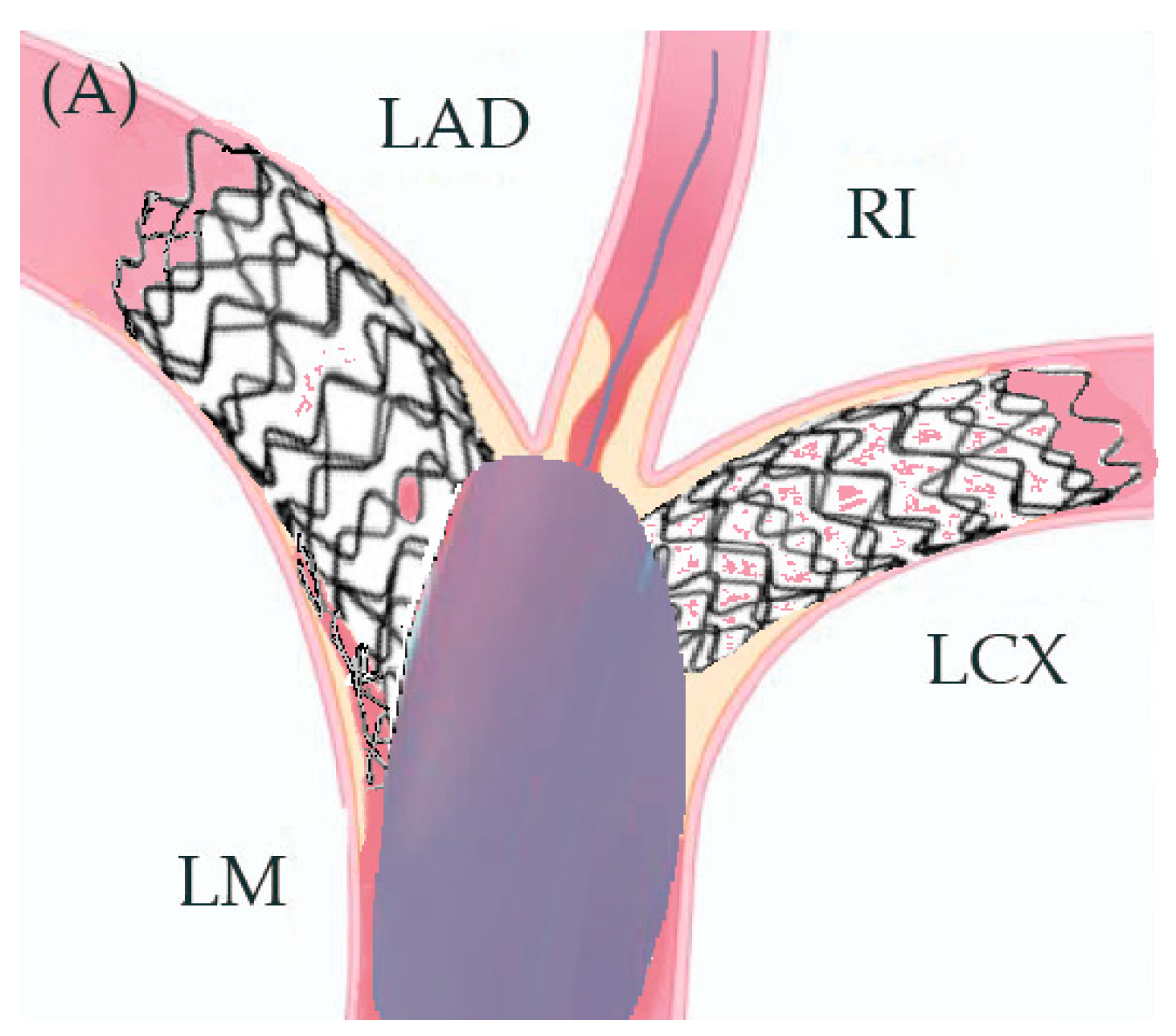 Complex Left Main Trifurcation: A Case Study of Successful Treatment