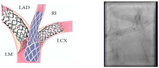 Complex Left Main Trifurcation: A Case Study of Successful Treatment