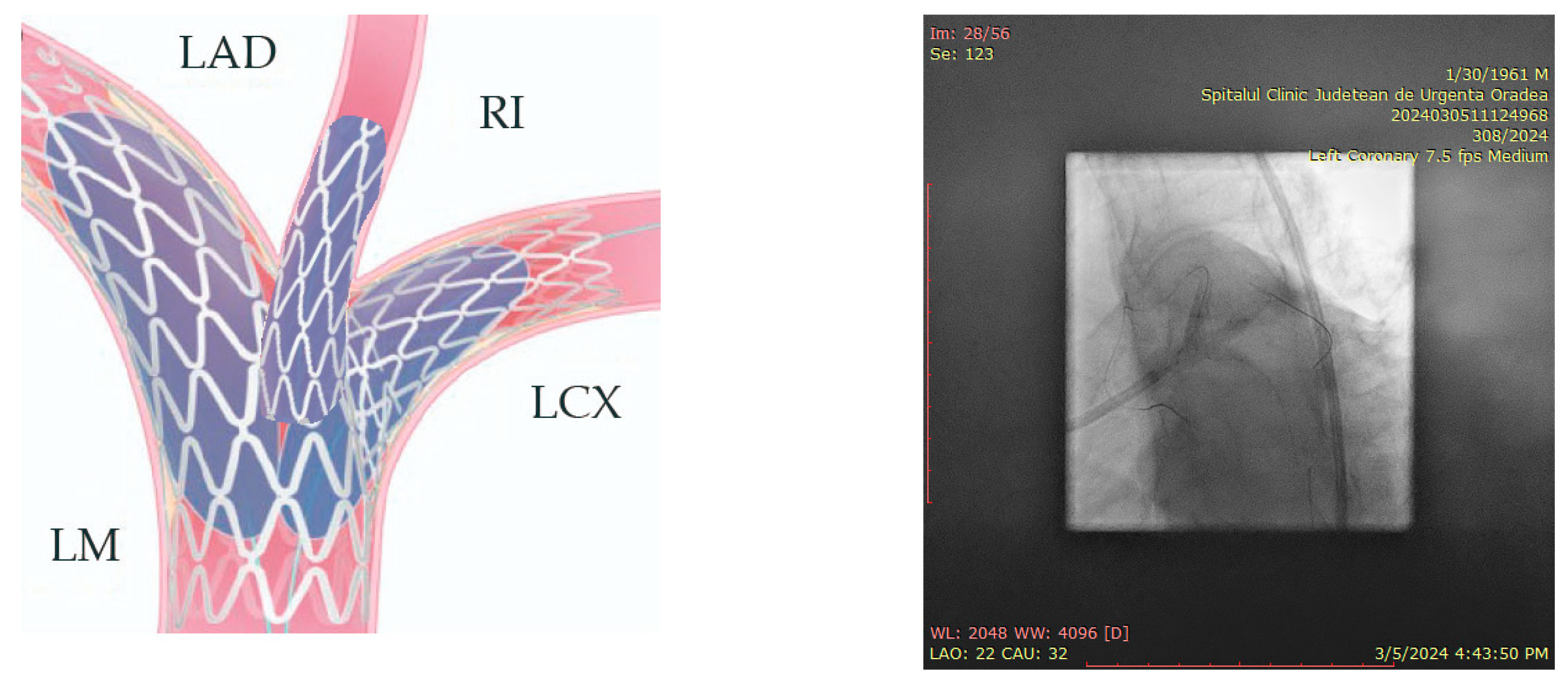 Complex Left Main Trifurcation: A Case Study of Successful Treatment