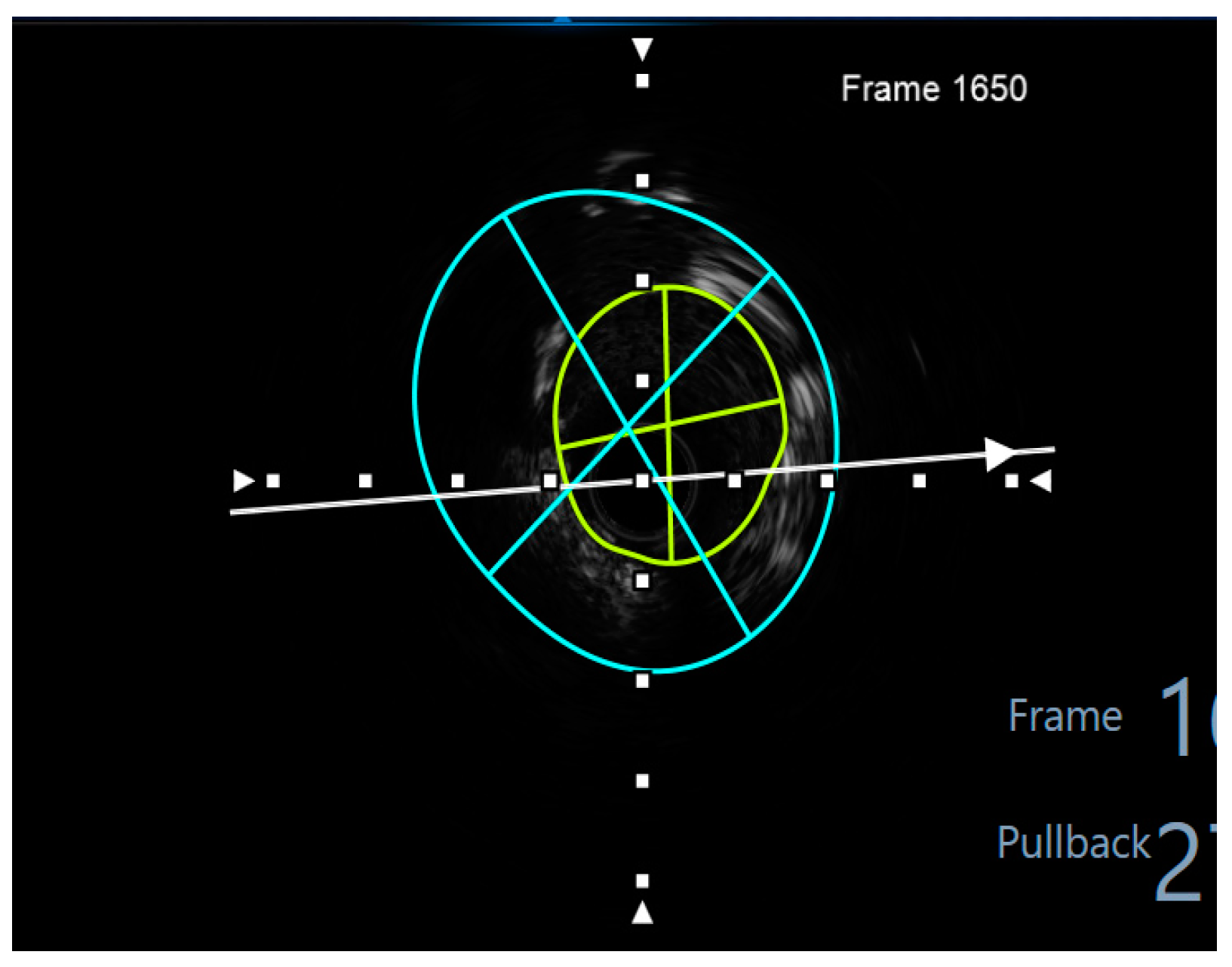 Complex Left Main Trifurcation: A Case Study of Successful Treatment