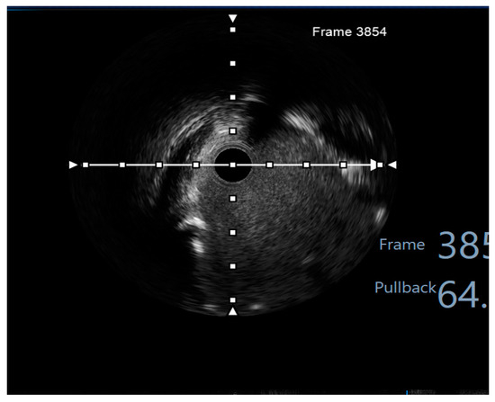 Complex Left Main Trifurcation: A Case Study of Successful Treatment