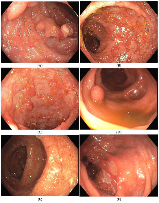 The Importance of Post-Inflammatory Polyps (PIPs) in Colorectal Cancer ...
