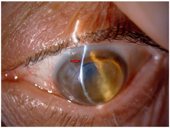 A Pilot Case Series on the Use of a Large Mushroom-Shaped Corneal Graft ...