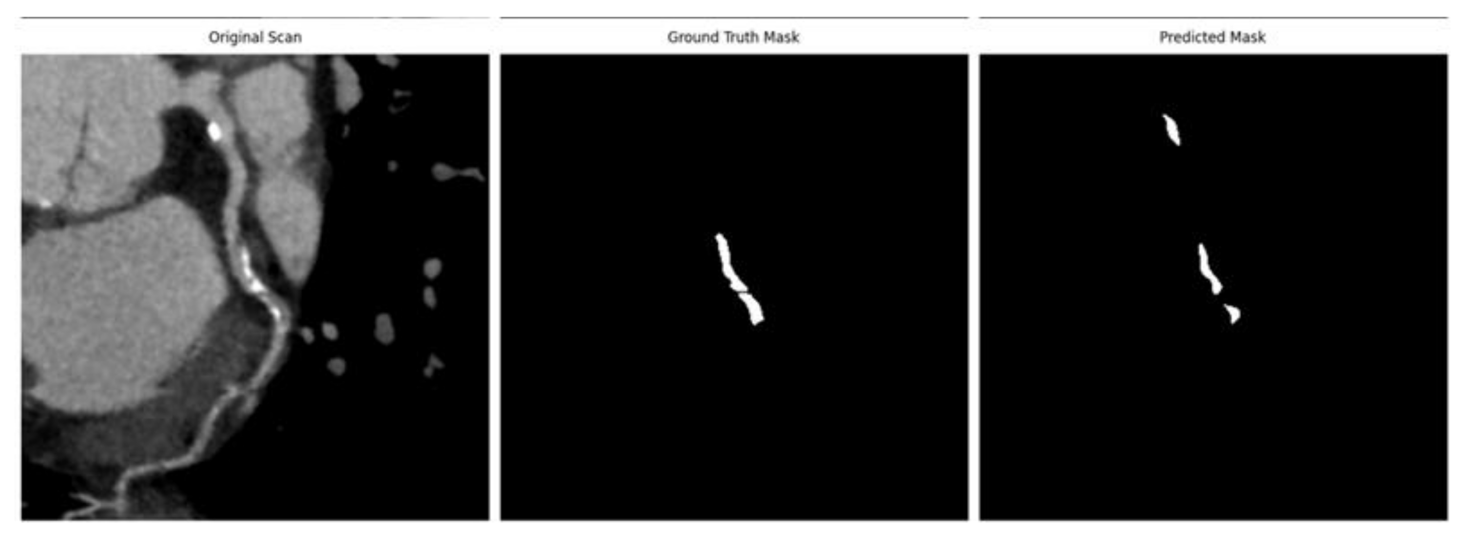 A Robust Blood Vessel Segmentation Technique for Angiographic Images Employing Multi-Scale ...