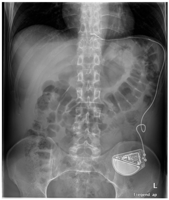 Therapeutic Management of Gastroesophageal Reflux Disease (GERD)—Is ...