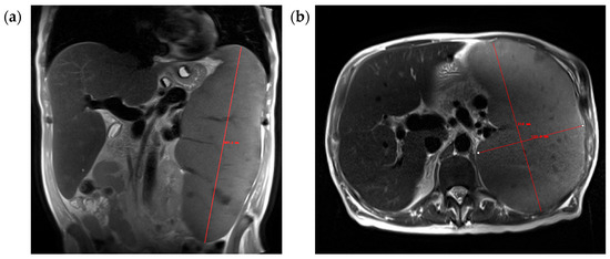 Model-Assisted Spleen Contouring for Assessing Splenomegaly in ...
