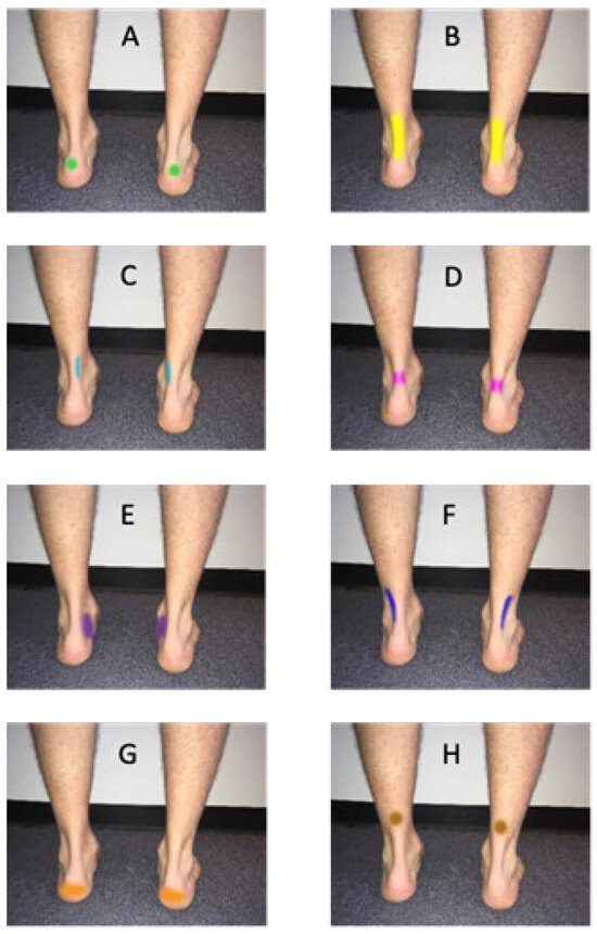 Do Anxiety, Depression, Fear of Movement and Fear of Achilles Rupture ...