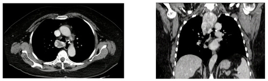 Prevalence and Clinical Risk Factors of Thyroid Cancer in Retrosternal ...