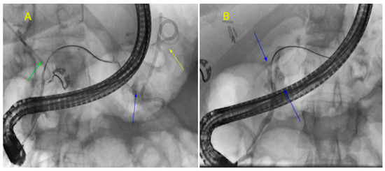 Endoscopic Management of Benign Pancreaticobiliary Disorders
