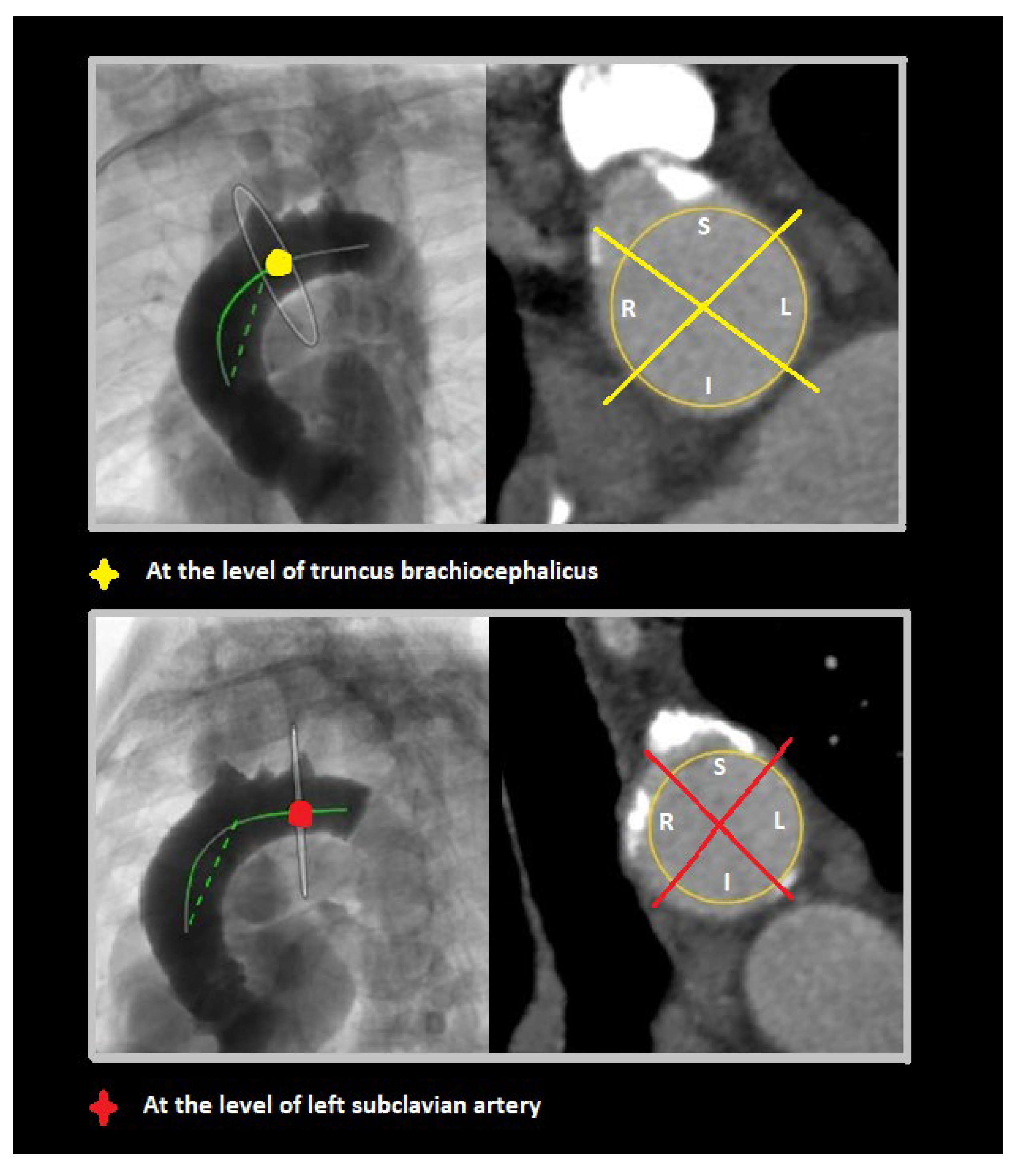 Analysis of Calcium Patterns in the Thoracic Aorta and Clinical ...