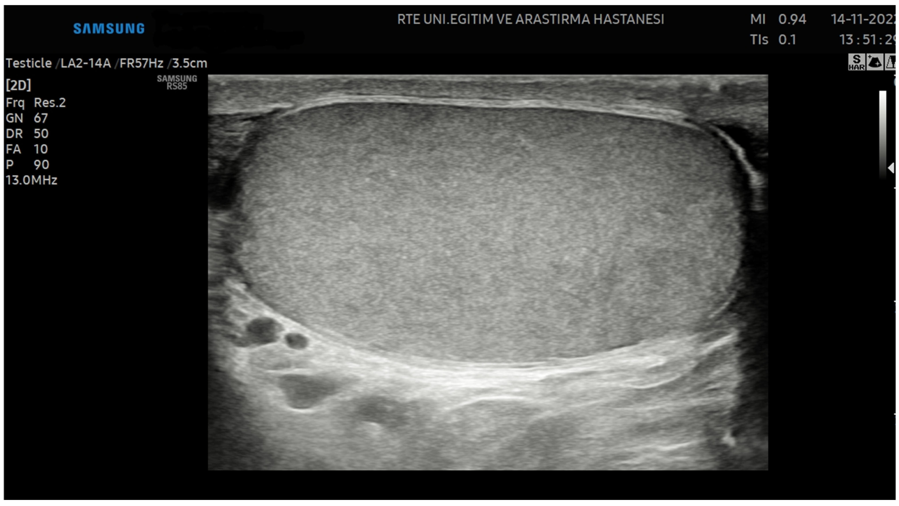 Predicting Semen Analysis Parameters from Testicular Ultrasonography ...