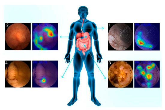 Explainable AI in Digestive Healthcare and Gastrointestinal Endoscopy