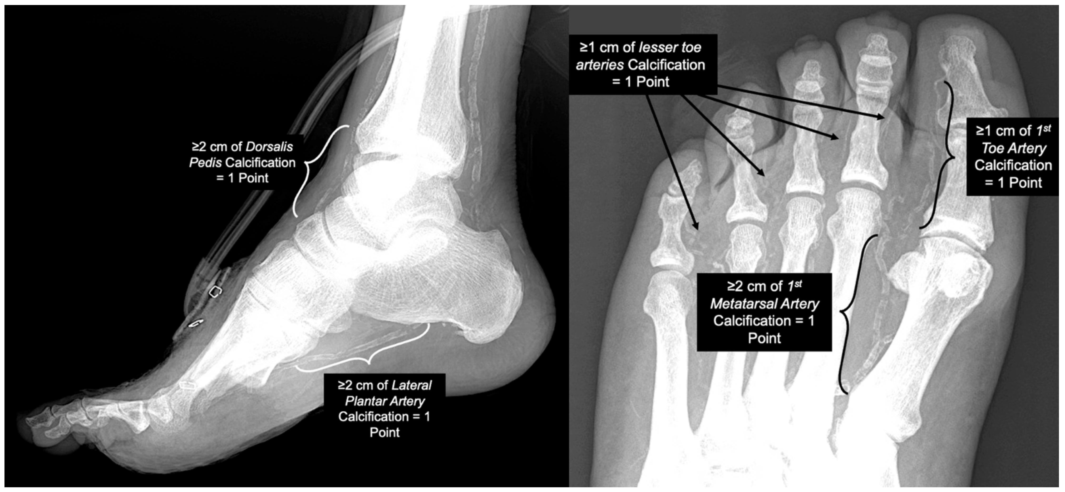 Understanding the Prevalence of Medial Arterial Calcification Among ...