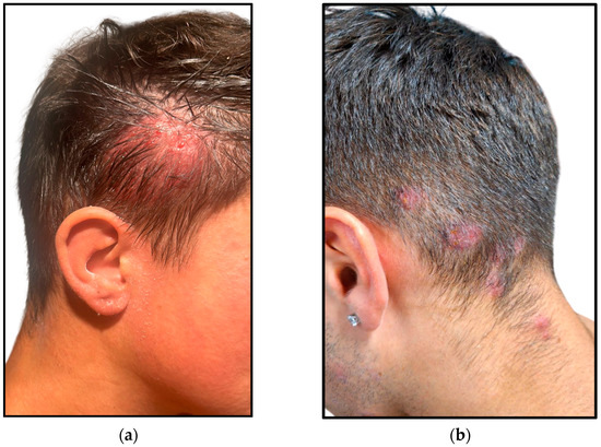 Tinea Capitis Induced by Barber Shaving: Isolation of Trichophyton ...