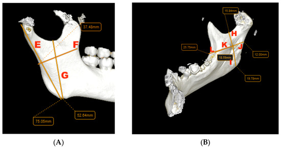 Imaging Retrospective Study Regarding the Variability of the Osseous ...