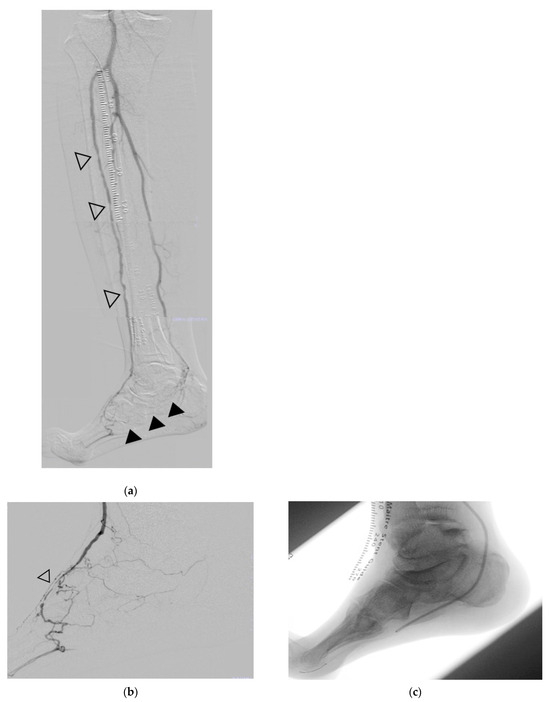A Case of Diabetic Ischemic Ulcer with Toe Deformity Successfully ...