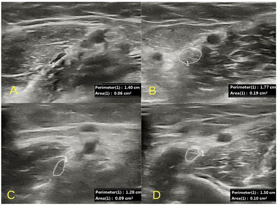 Unusual Symptoms of Lacertus Syndrome: A Case Report