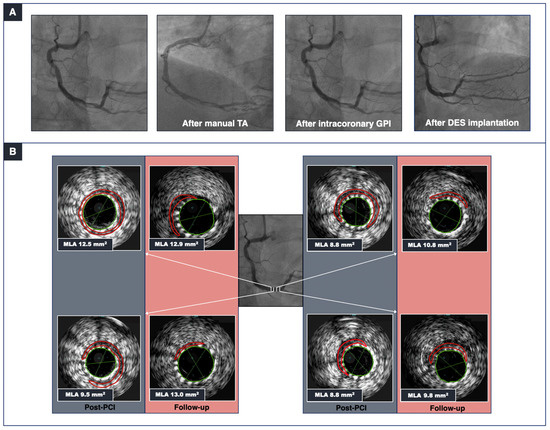 Percutaneous Revascularization of Thrombotic and Calcified Coronary Lesions