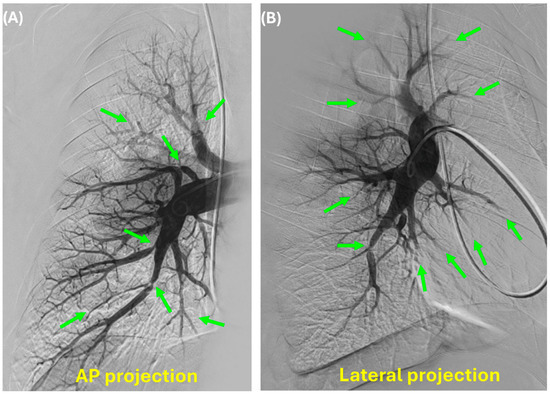 Evolution and New Perspectives of Balloon Pulmonary Angioplasty in CTEPH
