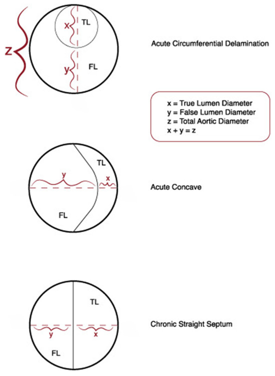 Aortic Remodeling After False Lumen Embolization in Aortic Dissection