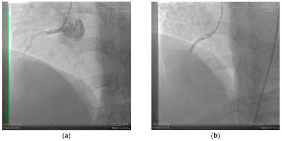 Kounis Syndrome in Clinical Practice: Insights from Clinical Case ...