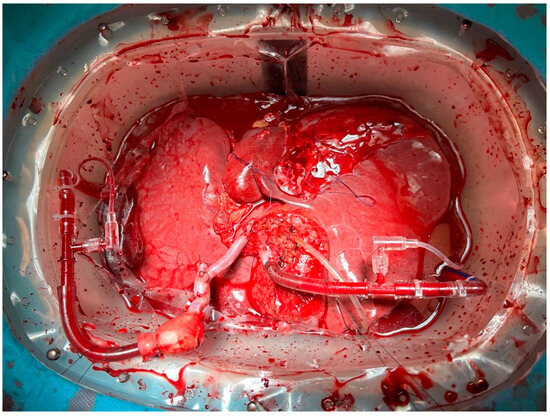 Normothermic Machine Perfusion in Orphan Liver Graft Viability Assessment