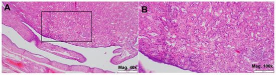 A Case Report of an Adenomatoid Tumor of the Fallopian Tube: The ...