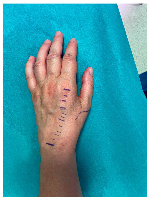 Return to Work After Subcutaneous Transposition of the Extensor Indicis ...